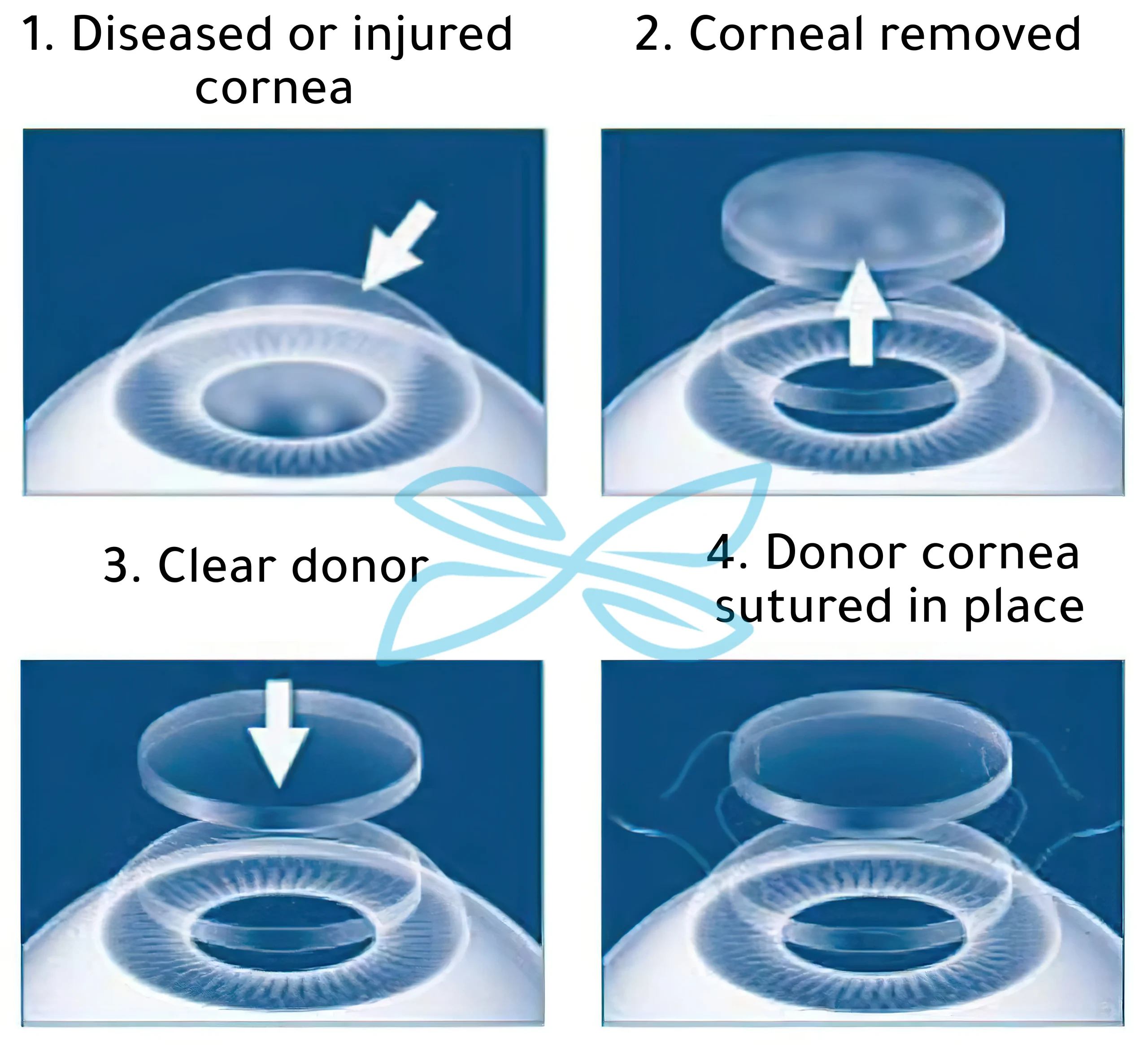 Corneal transplantation without stitches in Türkiye 2023 - Bimaristan
