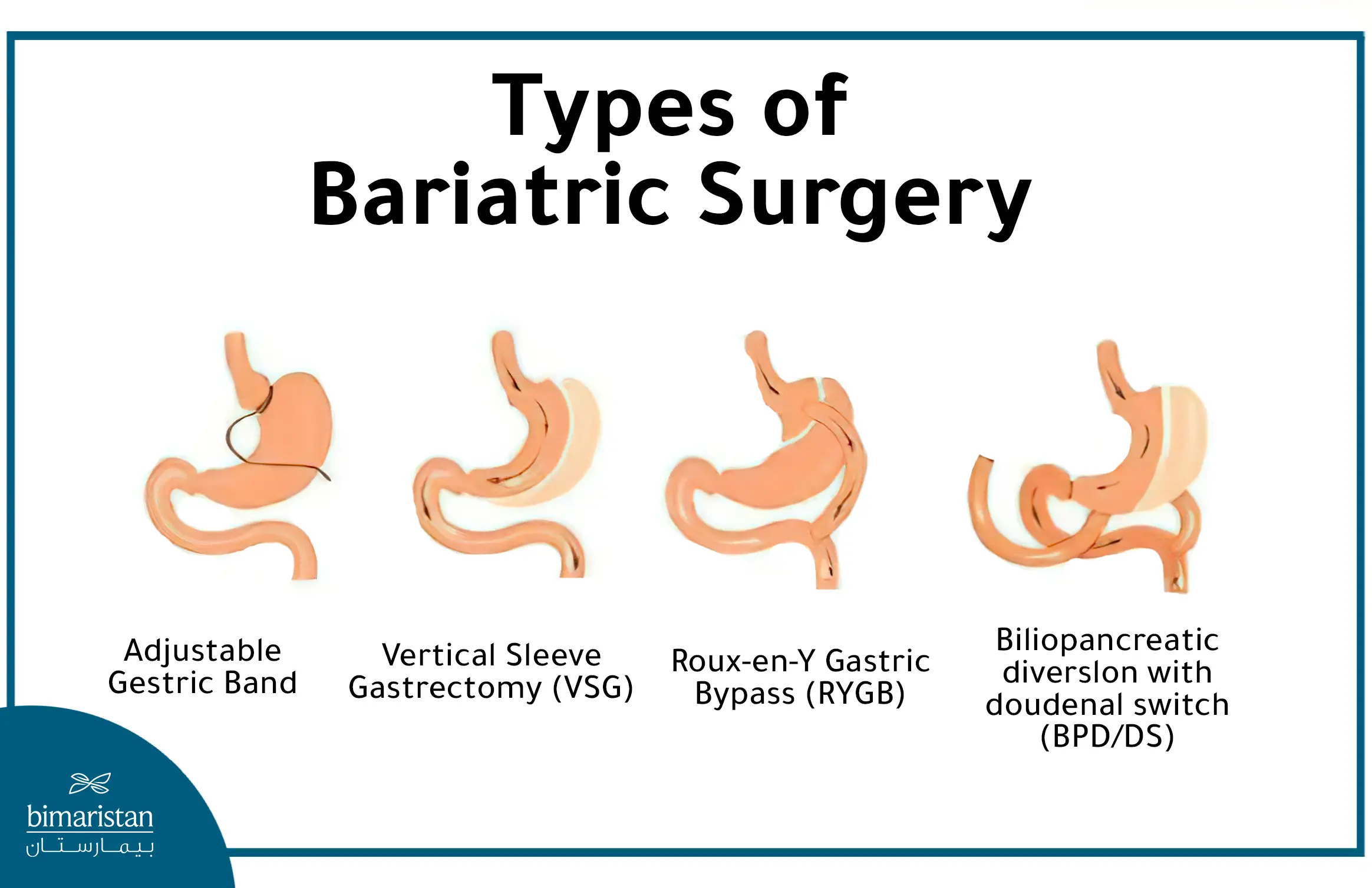 Types Of Bariatric Surgery In Turkey بيمارستان 4944
